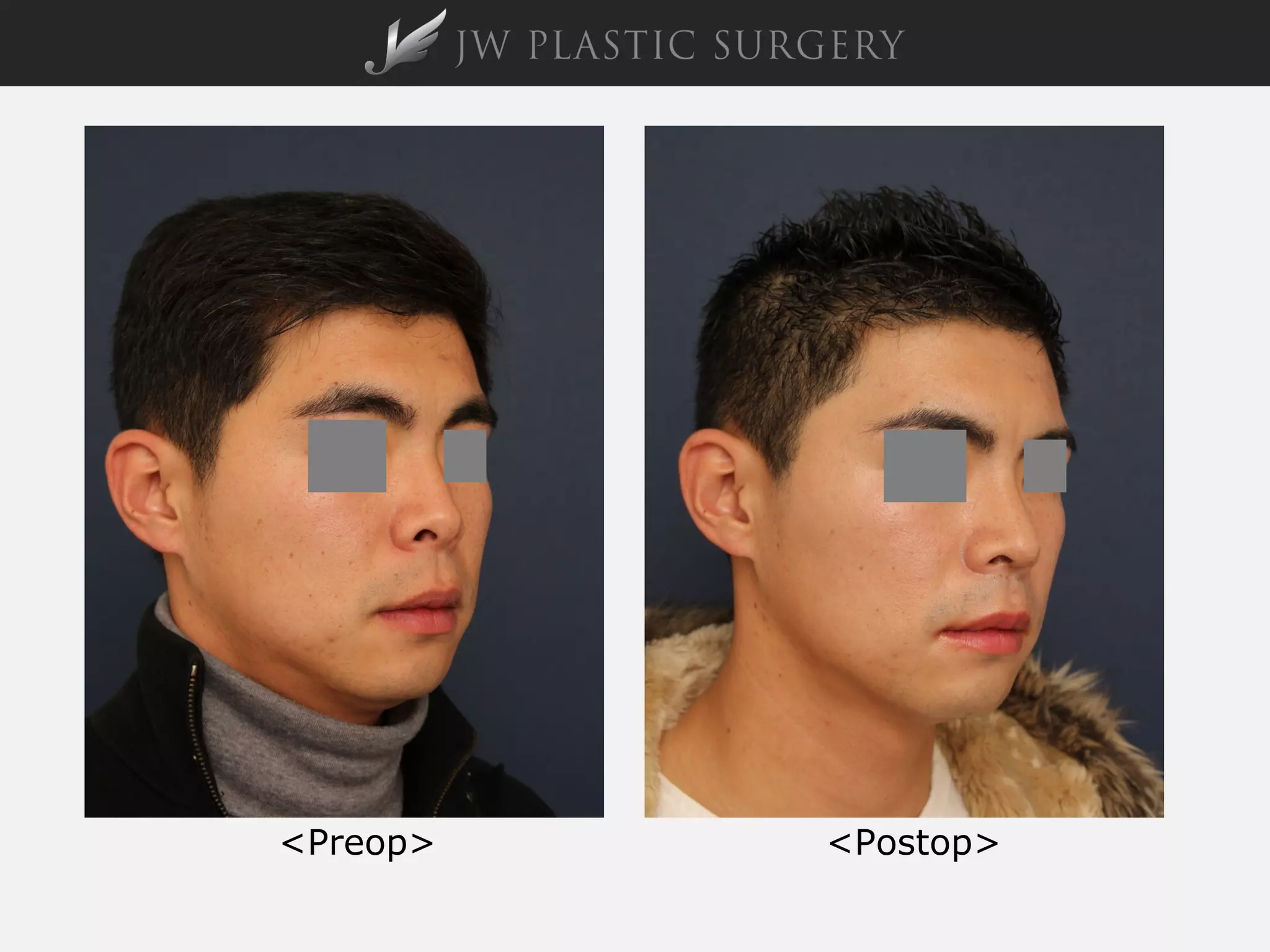 Hybrid septal extension graft for short nose correction | PPT
