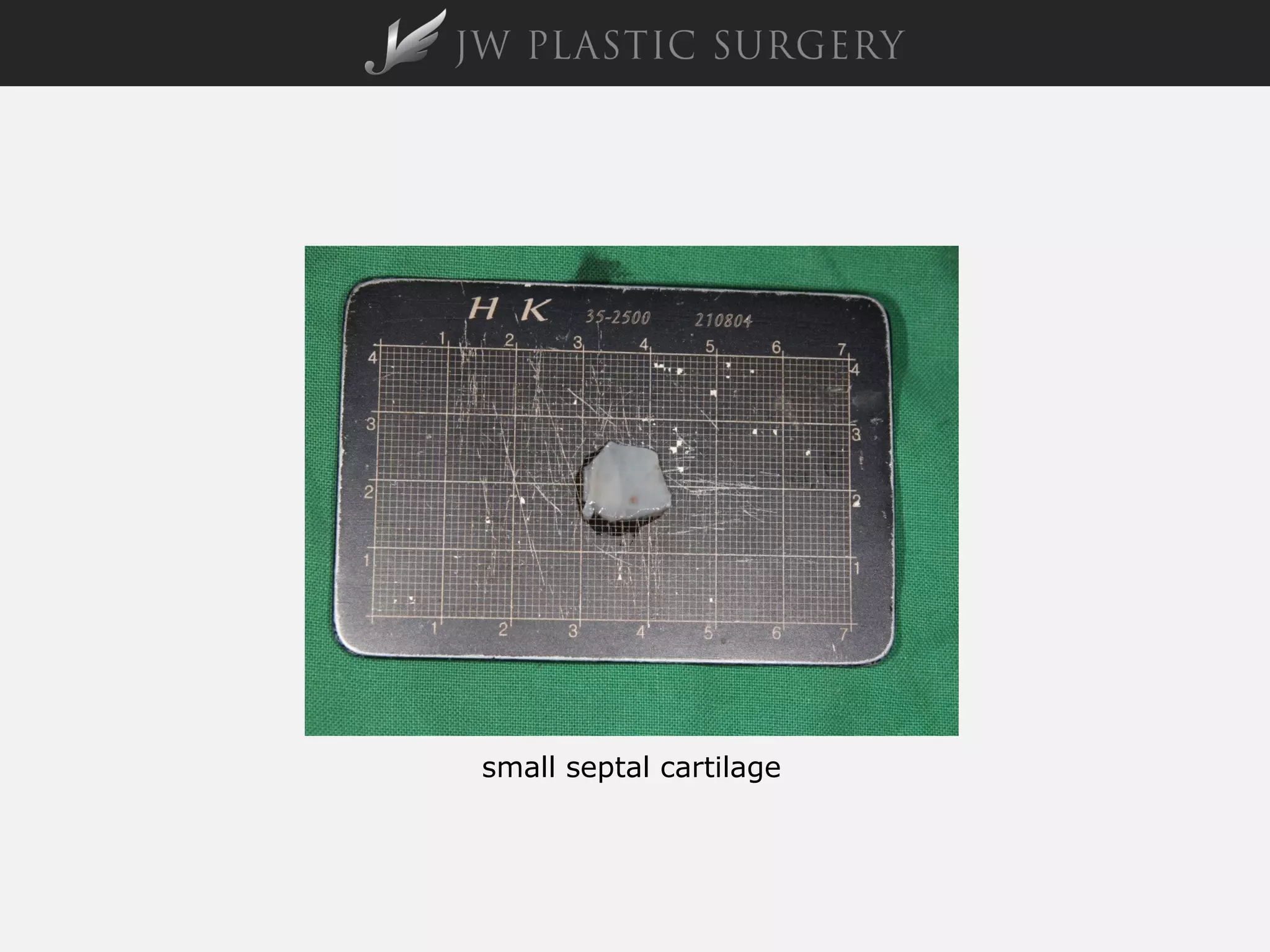 Hybrid septal extension graft for short nose correction | PPT