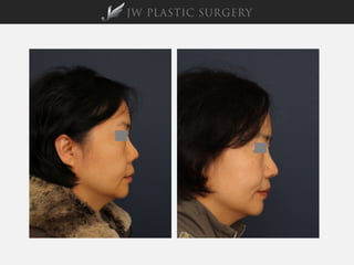 Hybrid septal extension graft for short nose correction | PPT