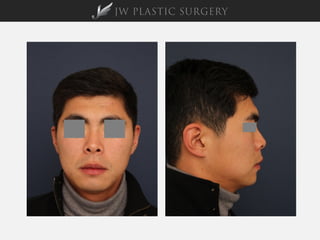 Hybrid septal extension graft for short nose correction | PPT