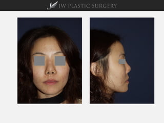 Hybrid septal extension graft for short nose correction | PPT