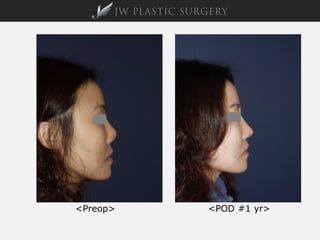 Hybrid septal extension graft for short nose correction | PPT