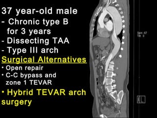 Hybrid tevar for the treatment of aortic dissection | PPT