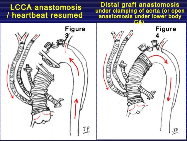Hybrid tevar for the treatment of aortic dissection