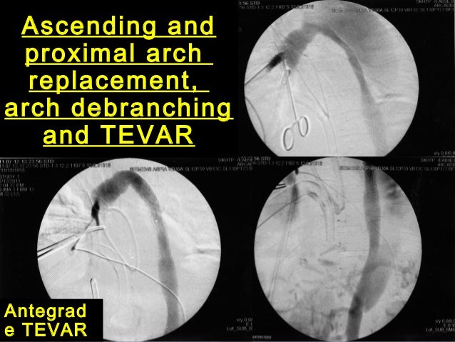 Hybrid tevar for the treatment of aortic dissection