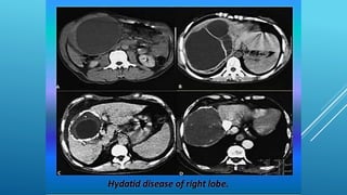 Hydated cyst liver | PPTX