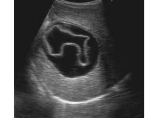 Hydatid cyst of liver and medical treatment | PPTX
