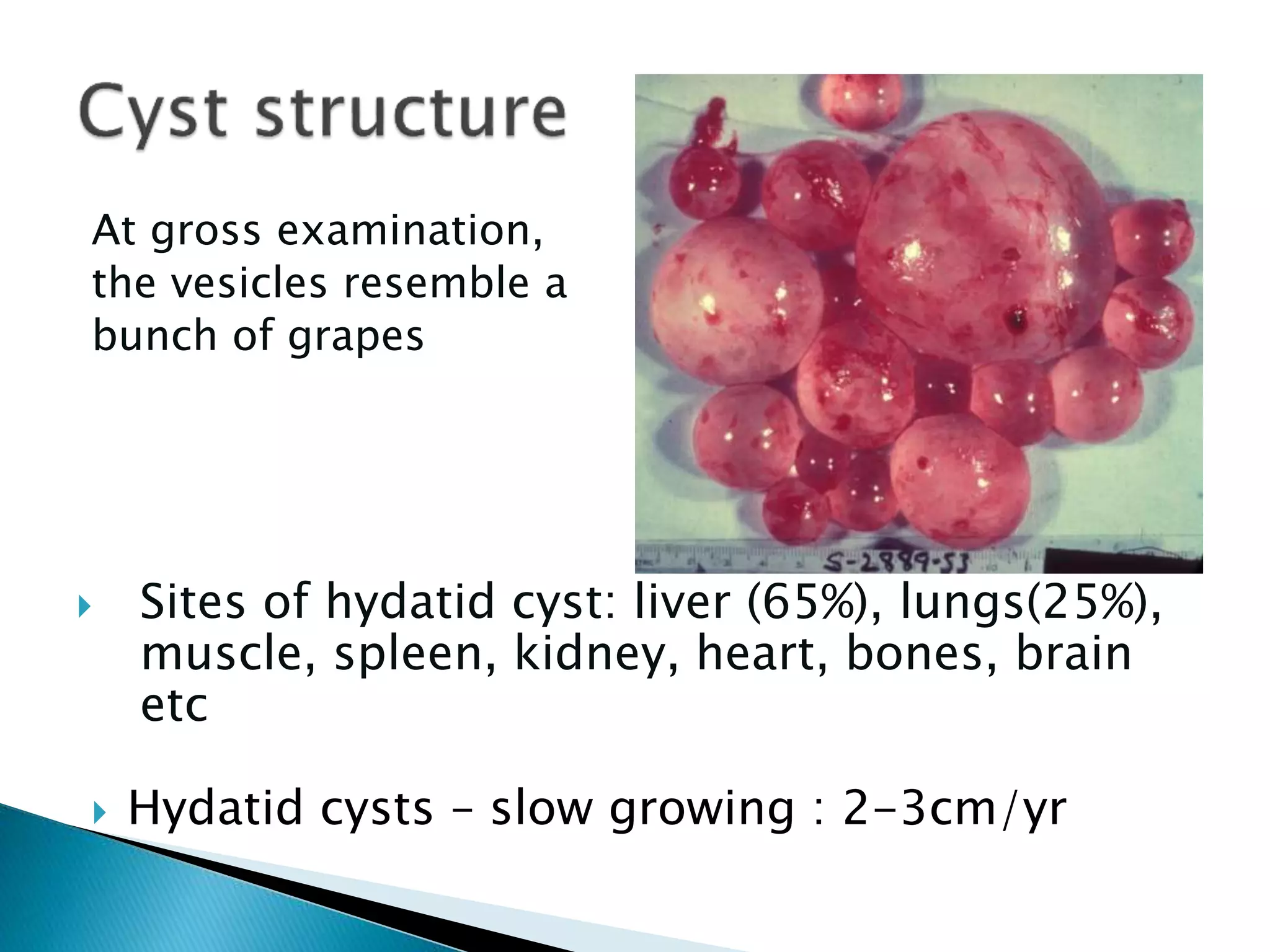 Hydatid cyst | PPTX