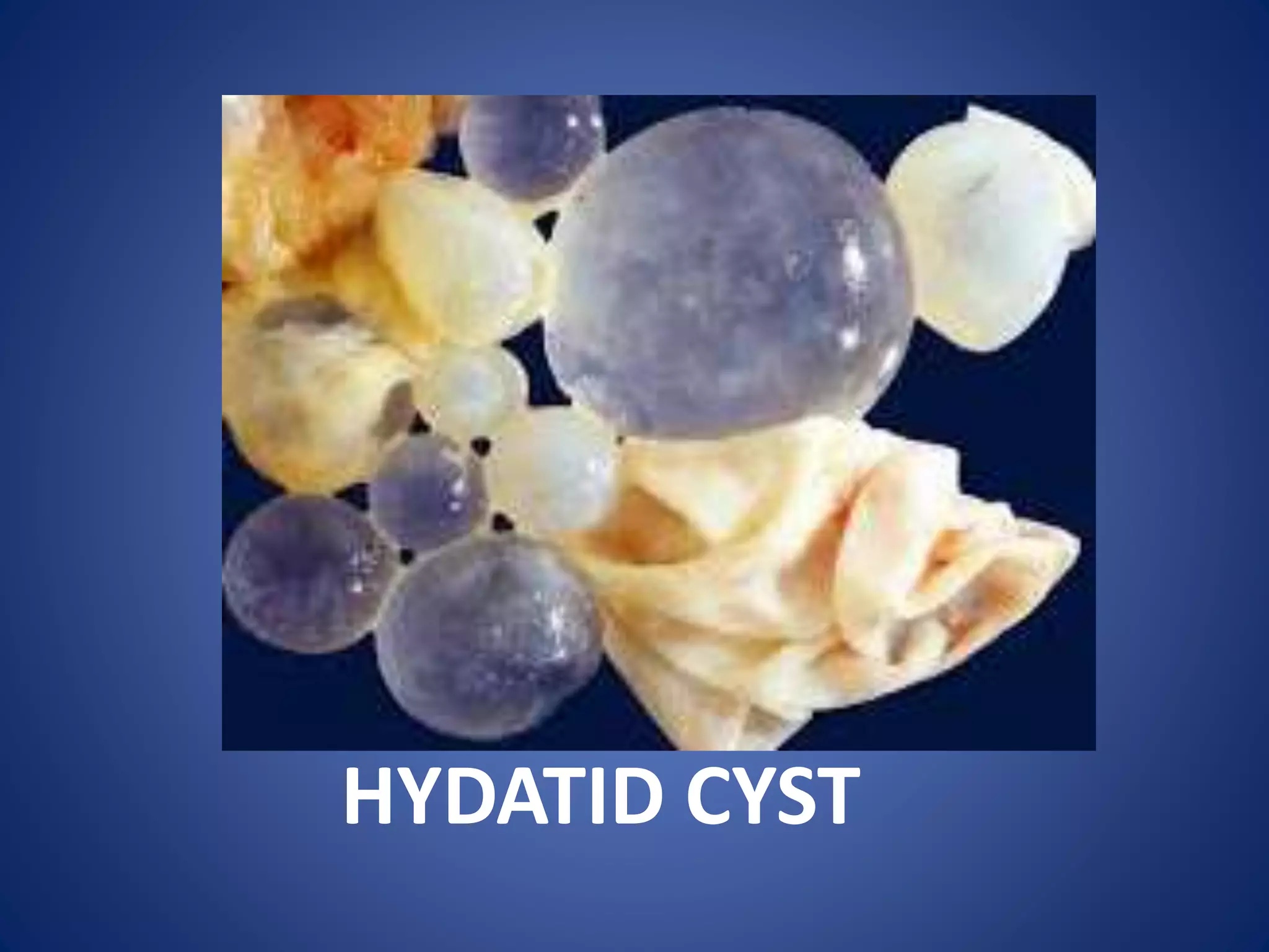 Hydatid cyst | PPTX