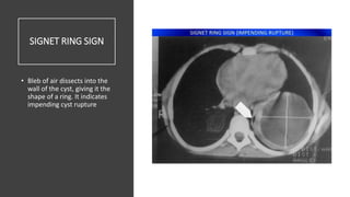 Hydatid cyst pulmonary | PPTX