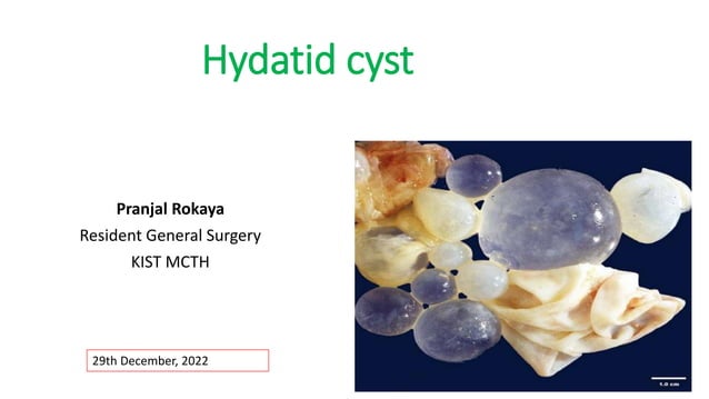 Hydatid Cyst | PPTX