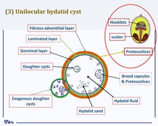 Hydatid cyst.pptx