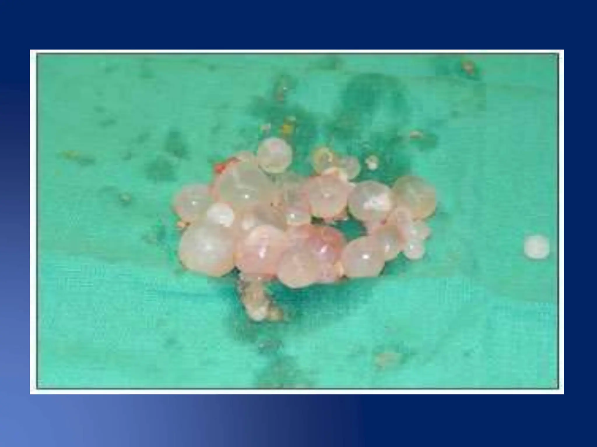 Hydatid Cyst Etiology And Presentation With Diagnosis Ppt