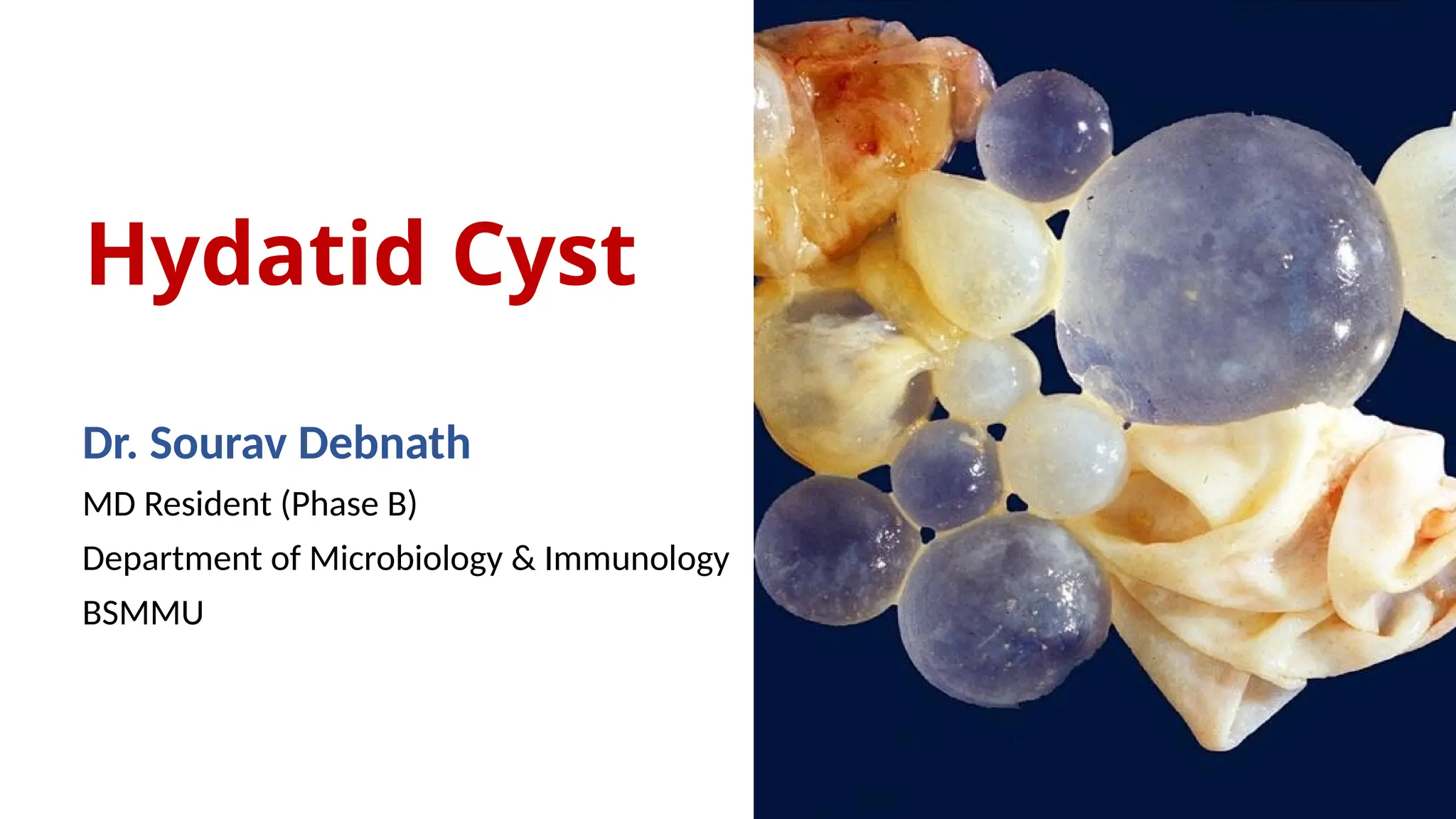 Hydatid Cyst: Pathogenesis, Clinical Manifestations, and Management ...
