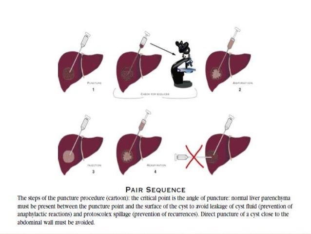 Hydatid cyst of liver by dr aakif