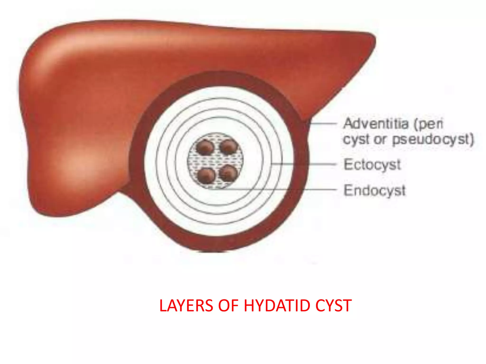 HYDATID CYST OF THE LIVER | PPTX
