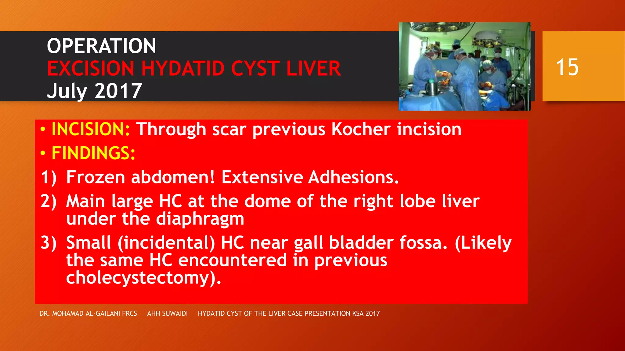 Hydatid Cyst of the liver, case presentation. KSA 2017 | PPTX