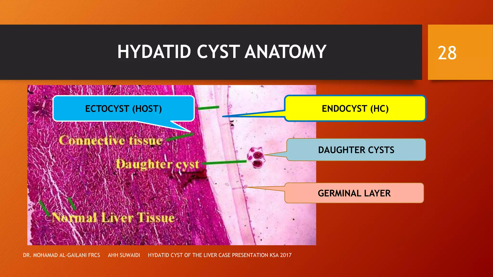 Hydatid Cyst of the liver, case presentation. KSA 2017 | PPTX