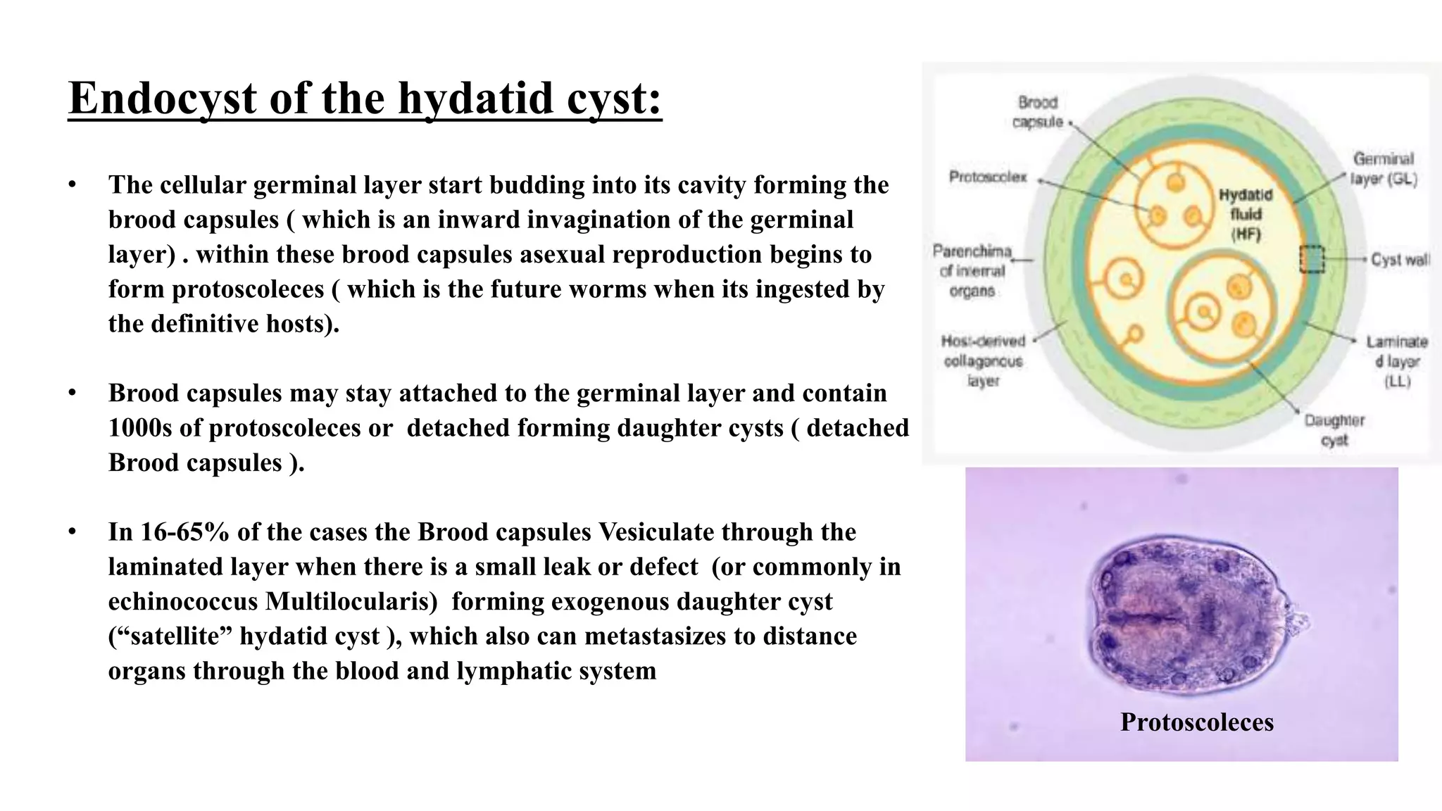 Hydatid cyst disease of the liver الدكتور طارق المنيزل | PPTX