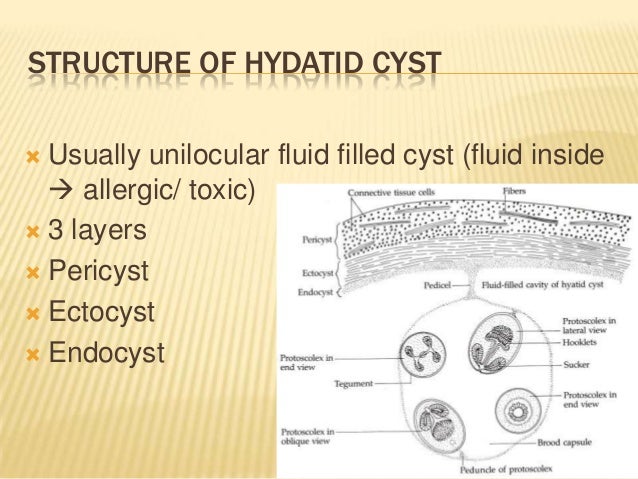 Hydatid cyst theva