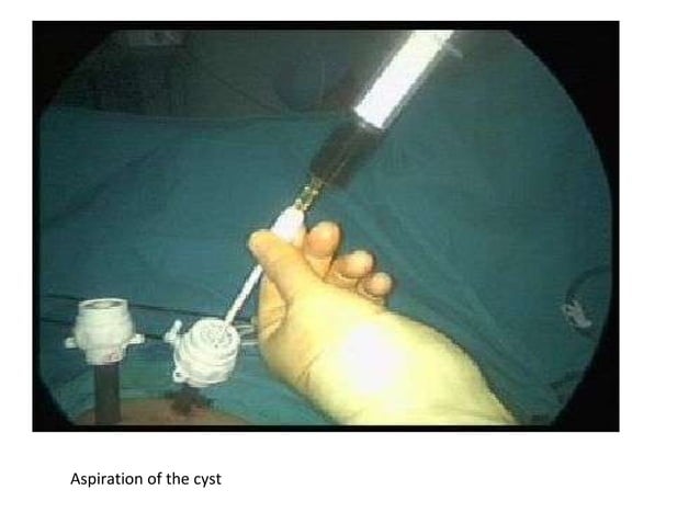 Laparoscopic Hydatid Cyst Treatment | PPT