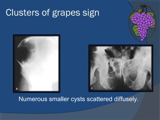 Hydatid disease | PPT