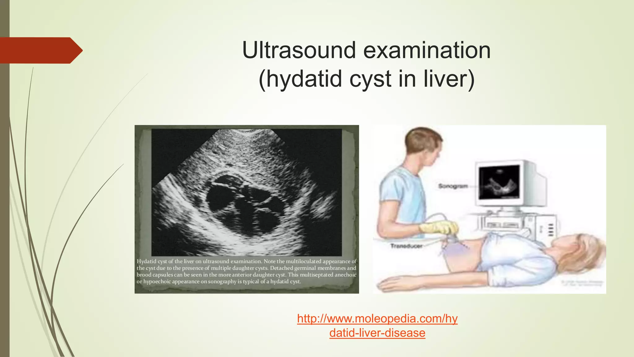 Hydatid disease | PPTX