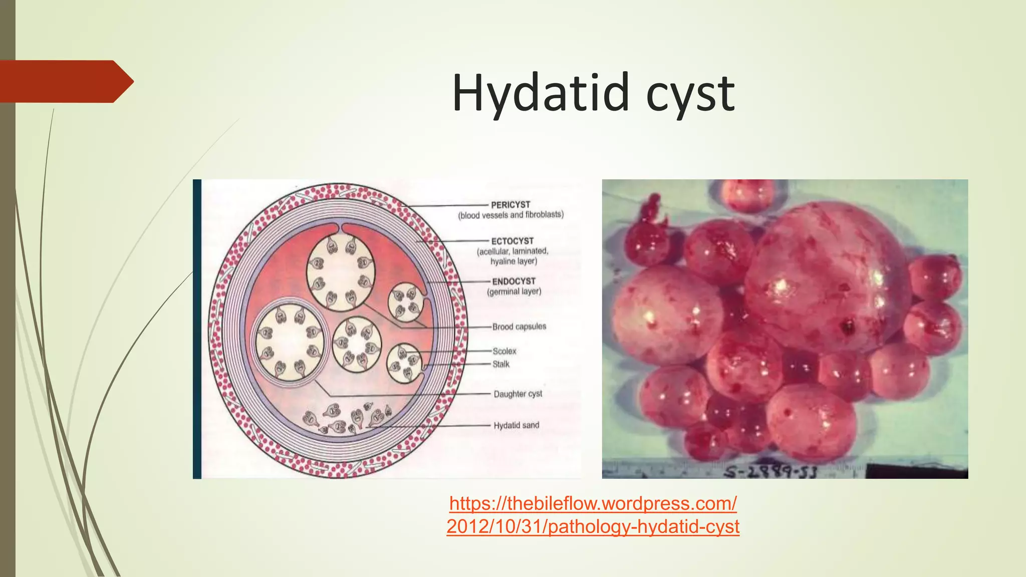 Hydatid disease | PPTX