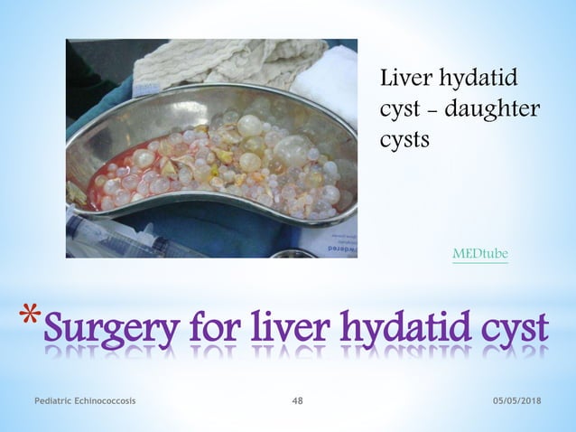 Hydatid disease | PPT