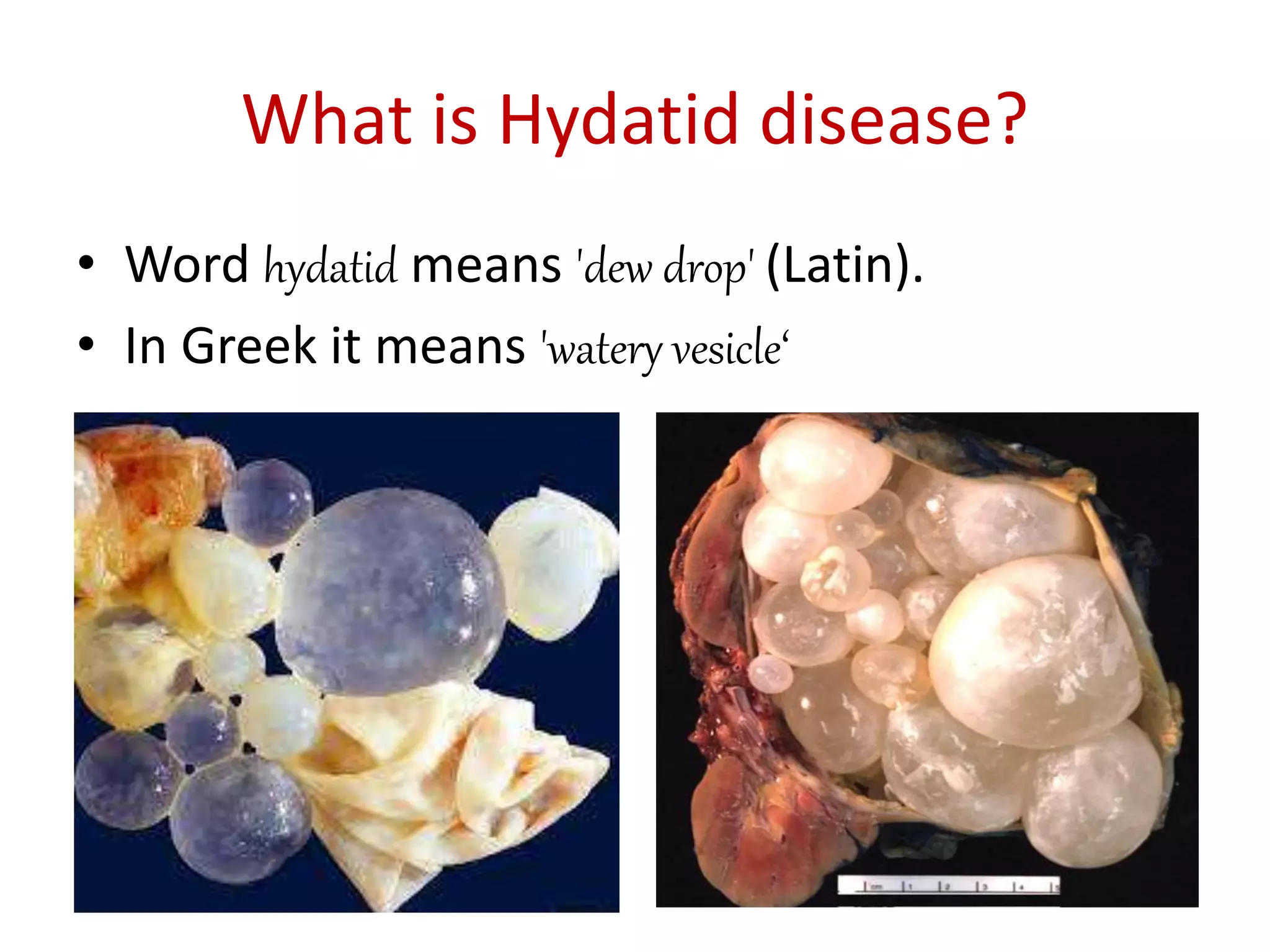 Hydatid disease | PPT