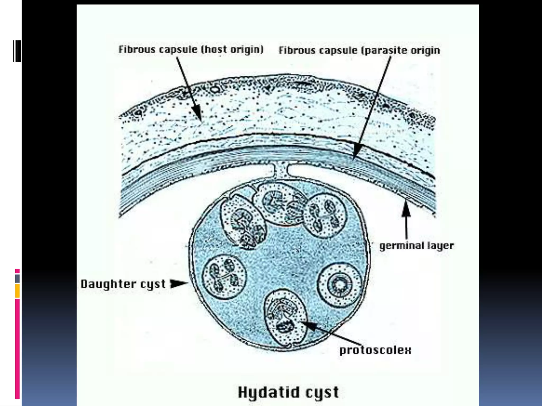 Hydatid disease of liver | PPTX | Lung and Respiratory Health ...
