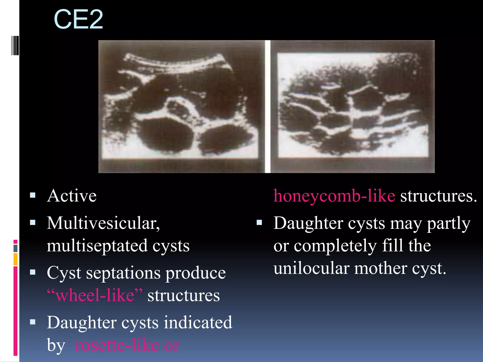 Hydatid disease of liver | PPTX
