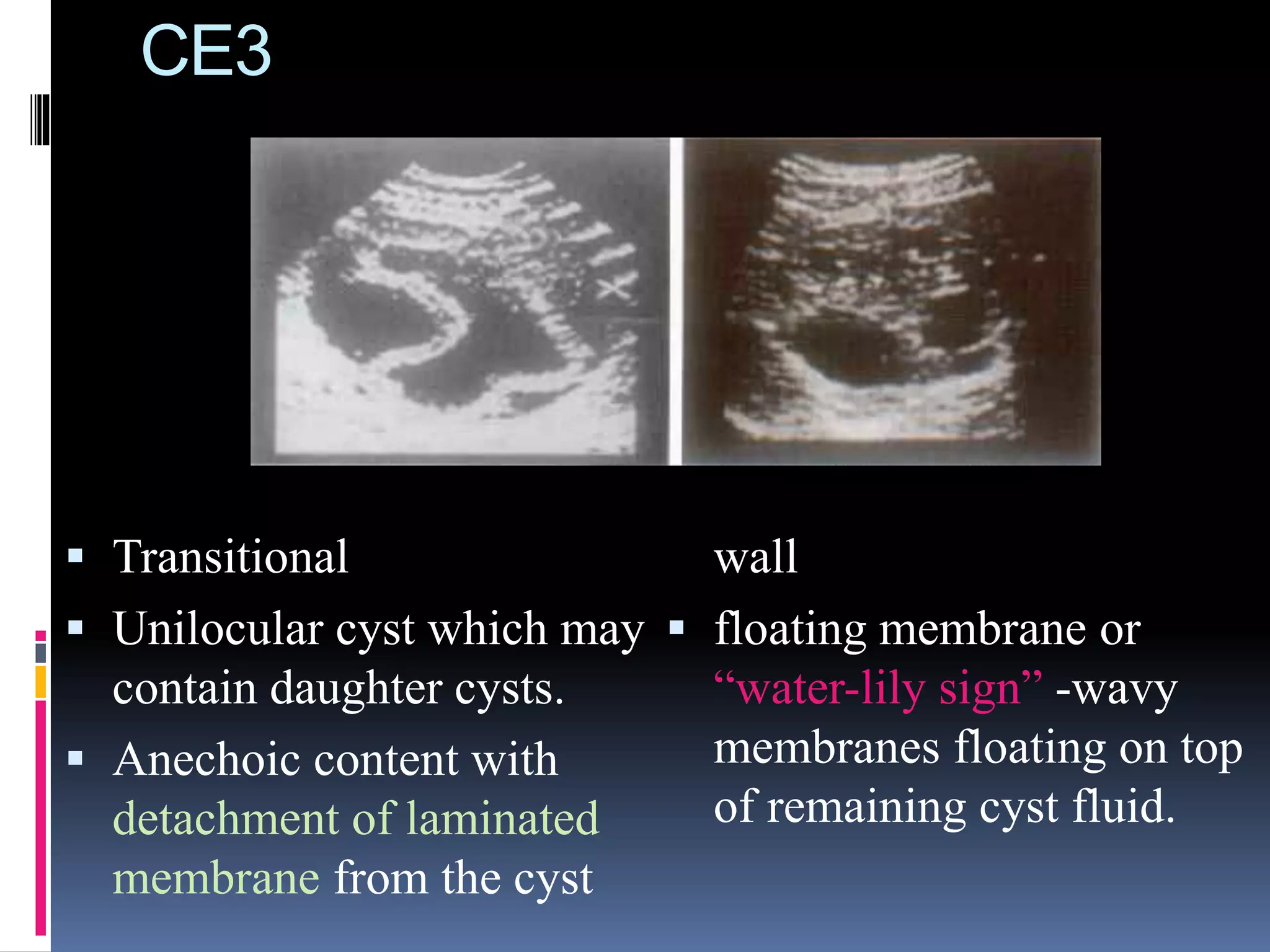 Hydatid disease of liver | PPTX