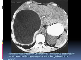 Hydatid disease of liver | PPTX