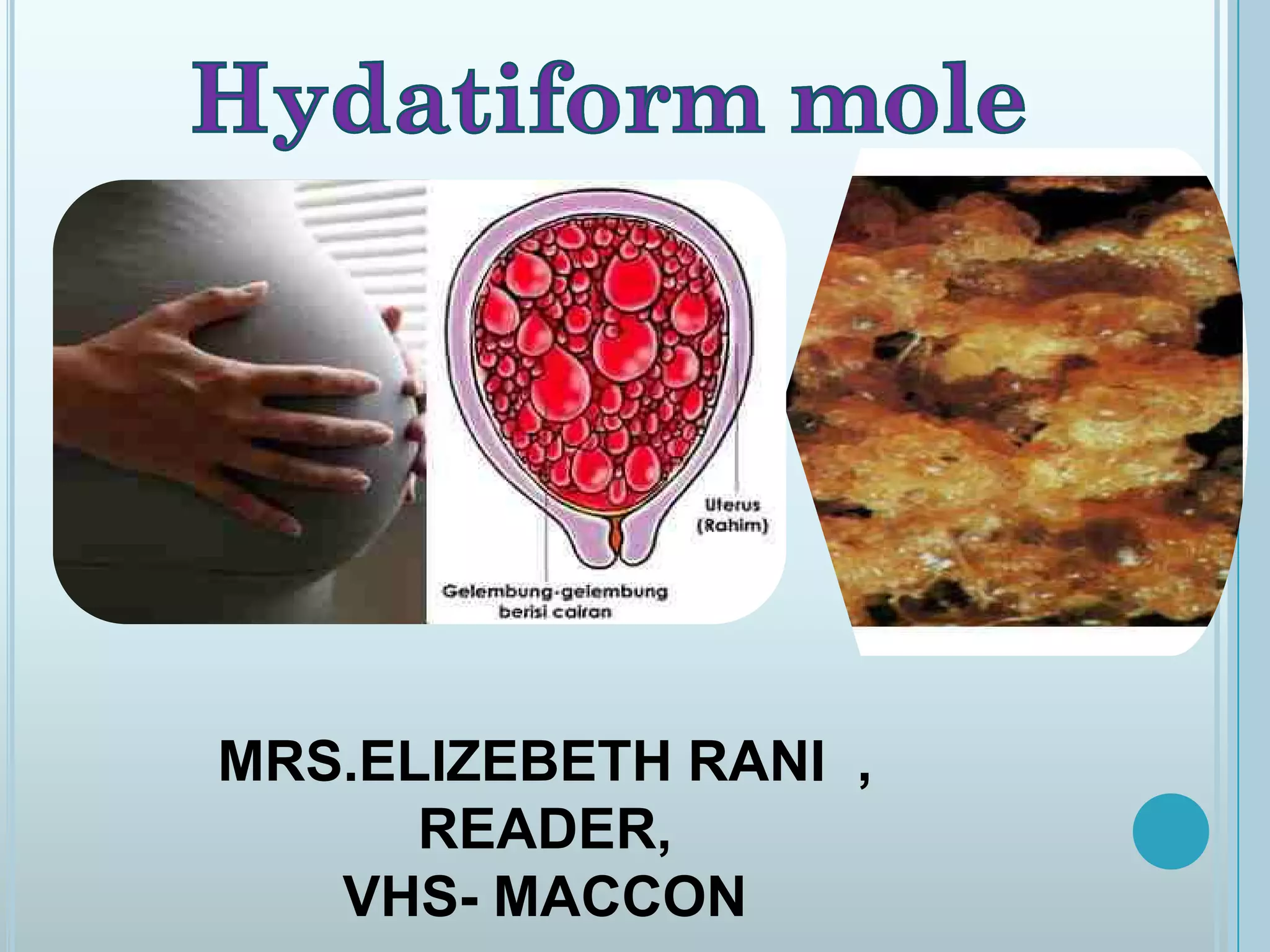 Hydatid form mole | PPT