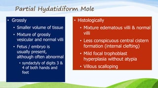 Hydatidiform mole | PPT
