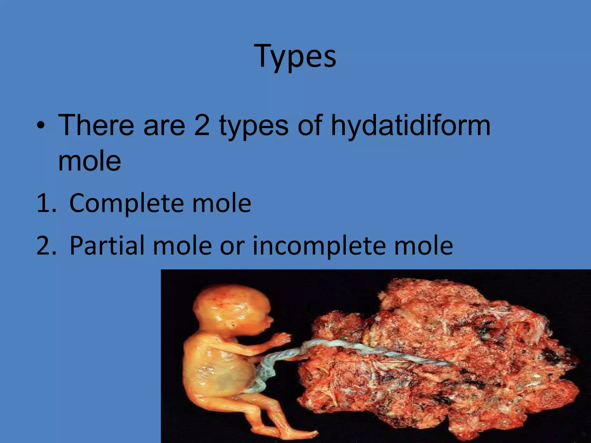 Hydatidiform mole | PPTX