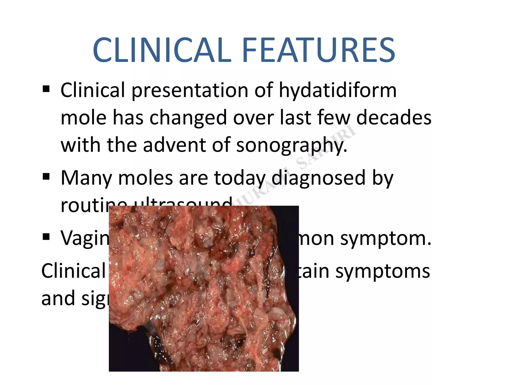 Hydatidiform mole/ VESICULAR MOLE | PPTX