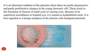 Hydatidiform mole | PPT