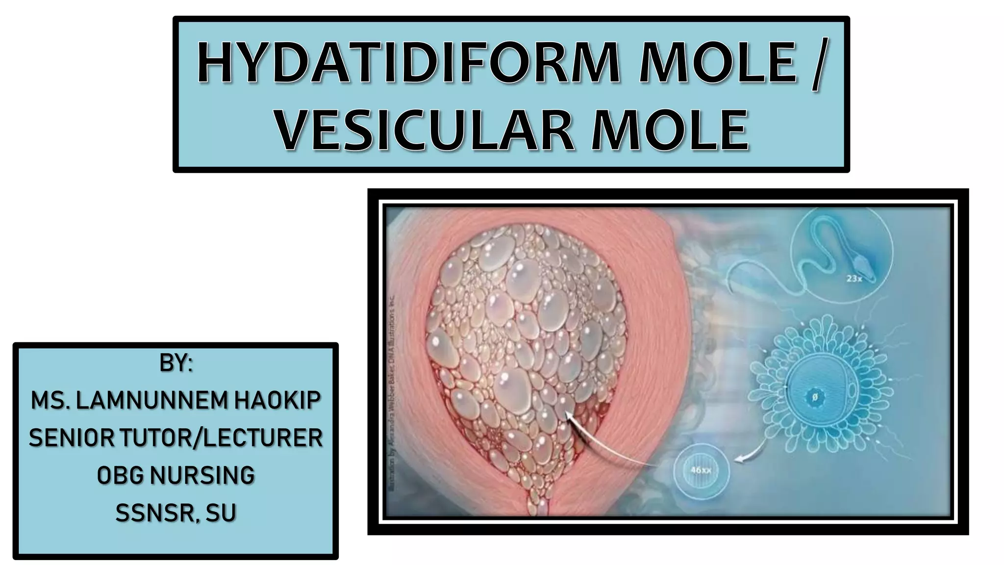 HYDATIDIFORM MOLE.pptx