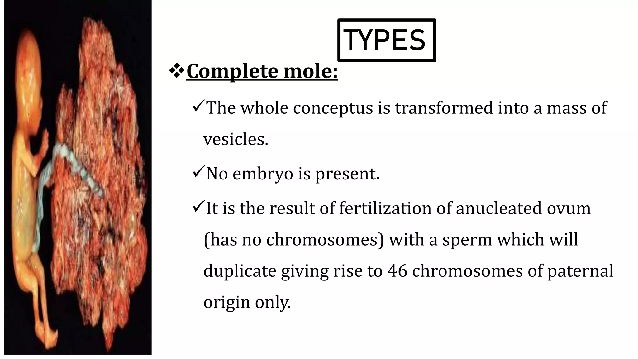 HYDATIDIFORM MOLE.pptx