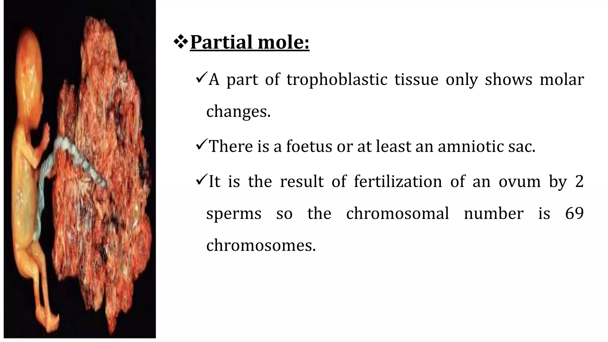 HYDATIDIFORM MOLE.pptx | Pregnancy | Reproductive Health