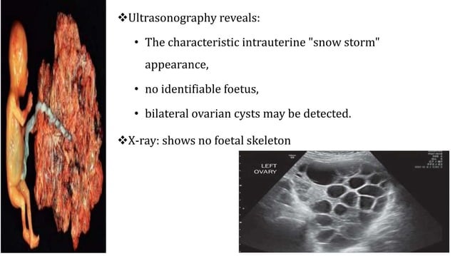 HYDATIDIFORM MOLE.pptx | Pregnancy | Reproductive Health
