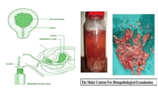 HYDATIDIFORM MOLE.pptx | Pregnancy | Reproductive Health