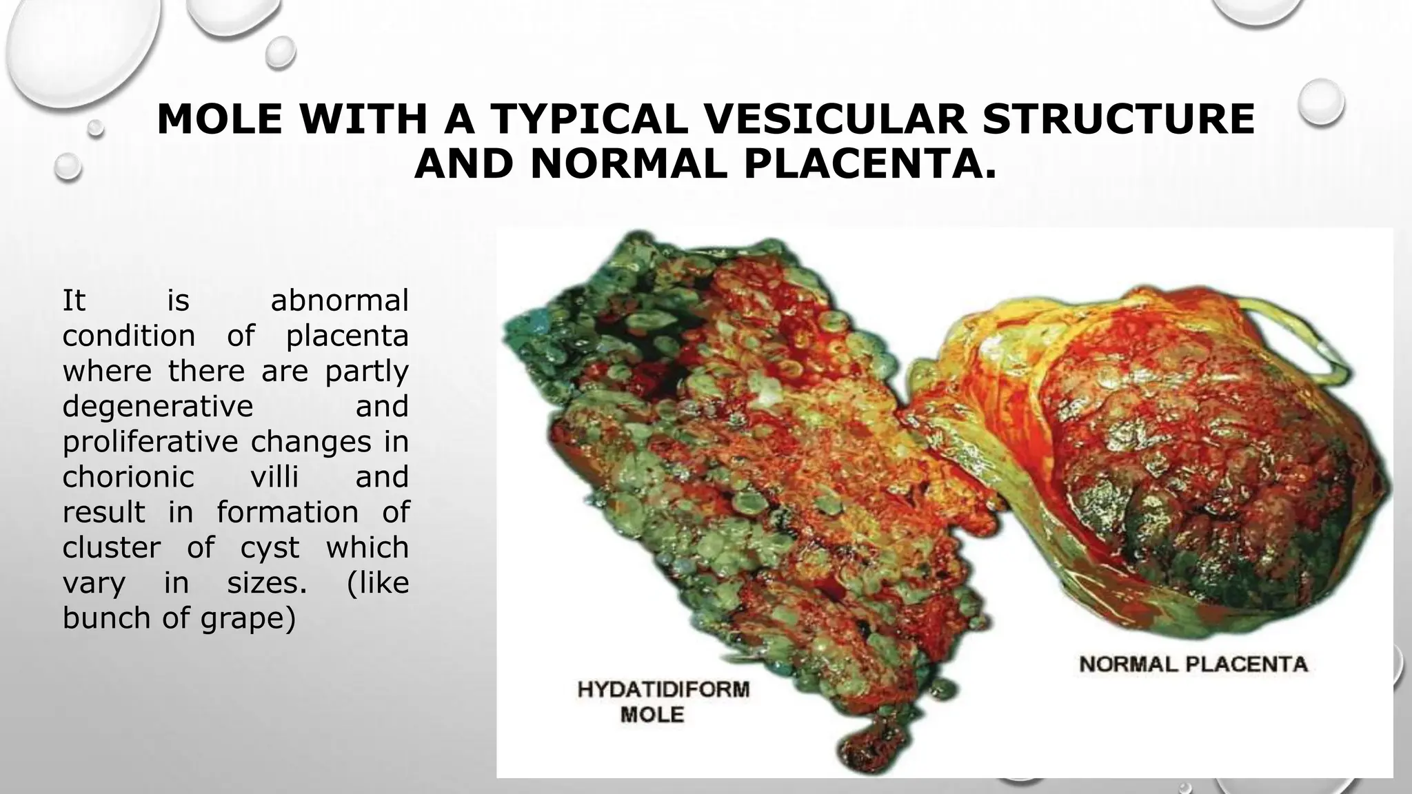 Hydatidiform Mole.pptx.pptx
