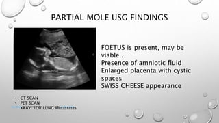 Hydatidiform Mole.pptx.pptx