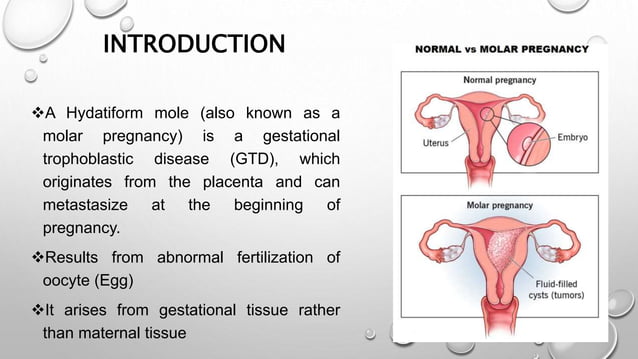 Hydatidiform Mole.pptx.pptx