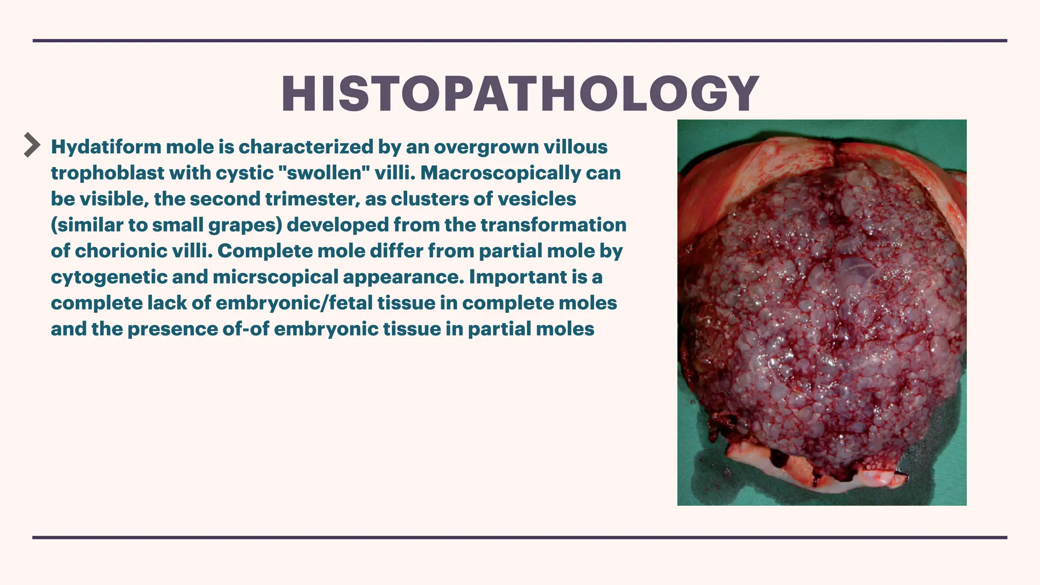 Hydatidiform mole gestational disease.pdf