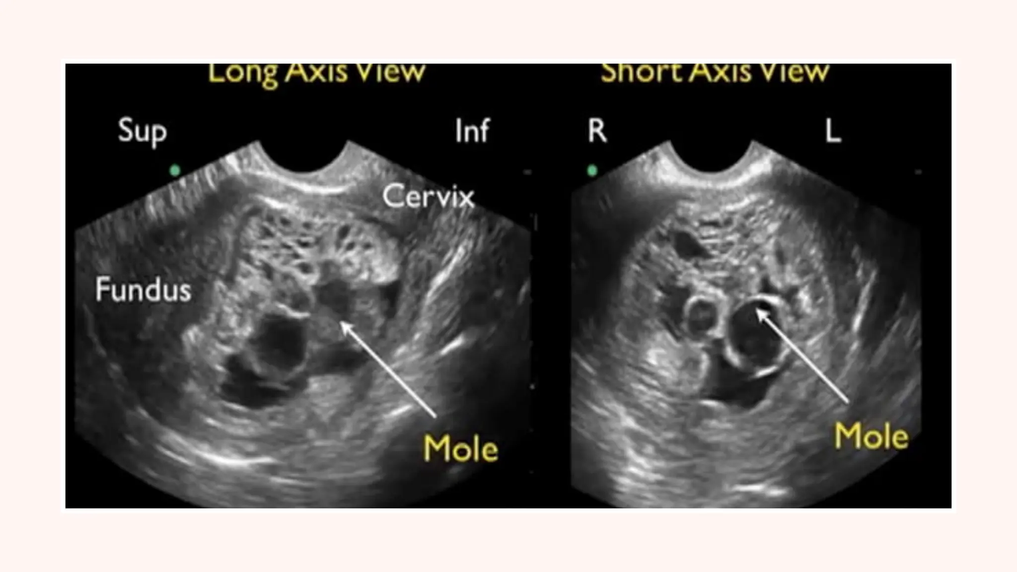 Hydatidiform mole gestational disease.pdf