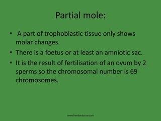 hydatidiformvesicularmole-100515015819-phpapp02.pdf